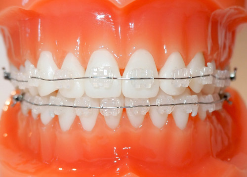 clear ceramic and metal braces | Orthododontics Perth - orthodontics perth
